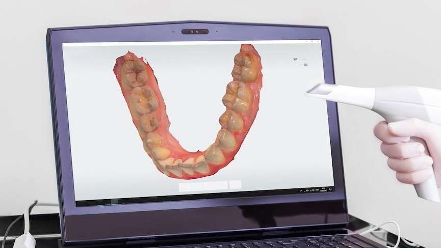 How Do We Use the iTero Scanner? | Invisalign Braces Fishers IN